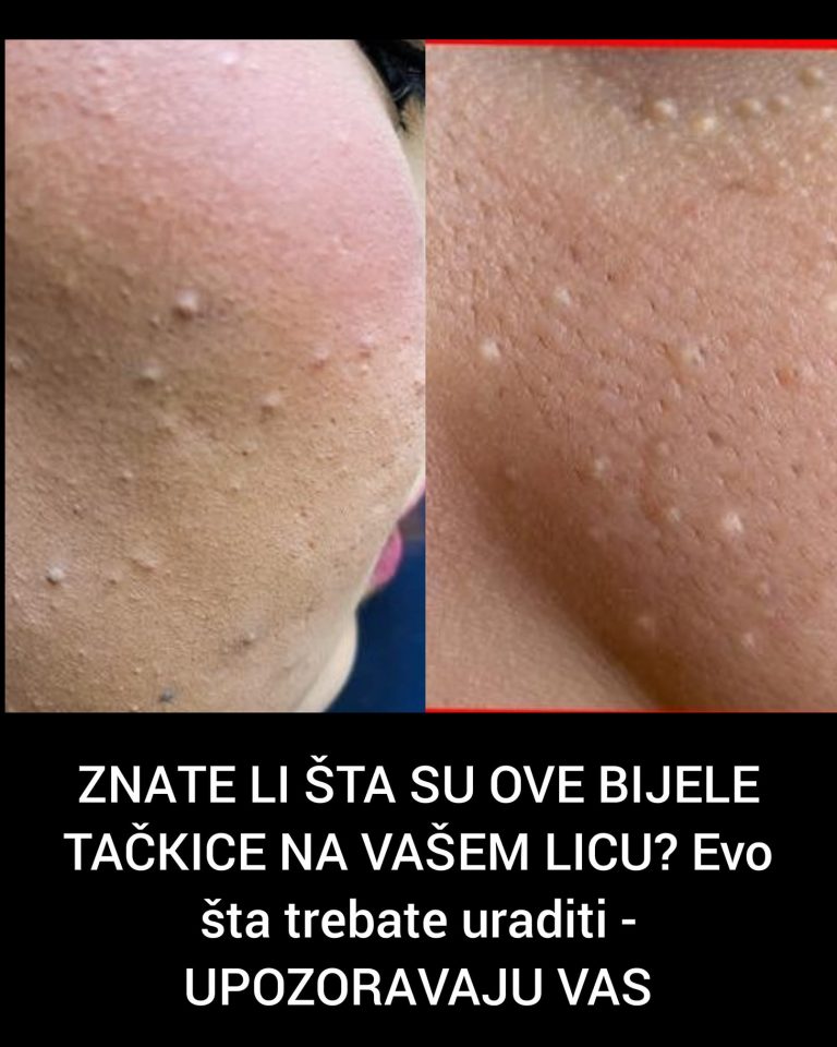 POGLEDAJTE ŠTA ZNAČE BIJELE TAČKICE PO VAŠEM TIJELU - BALKAN STORY